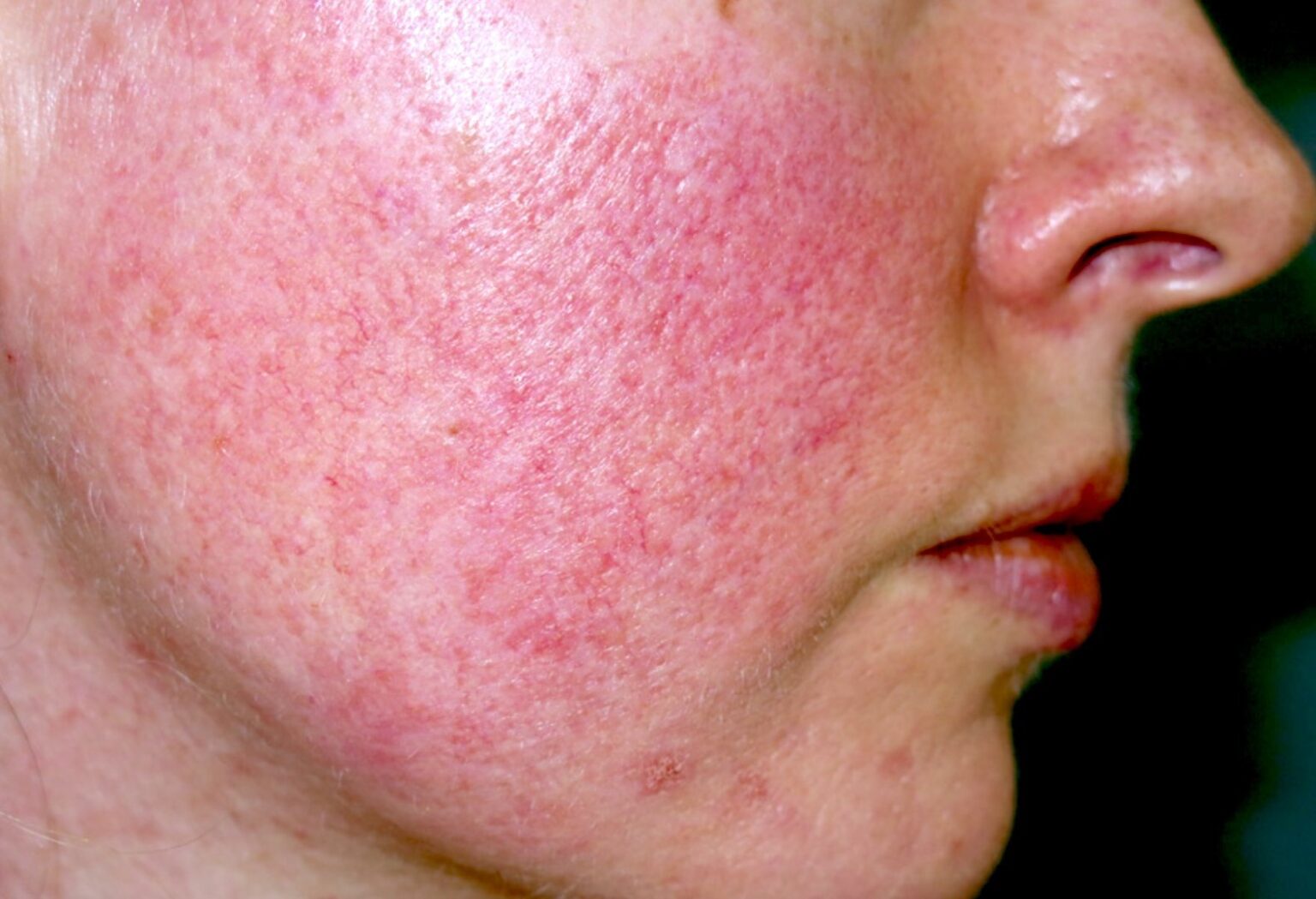 Red Lesions - 1Aesthetics, Medical & Surgery