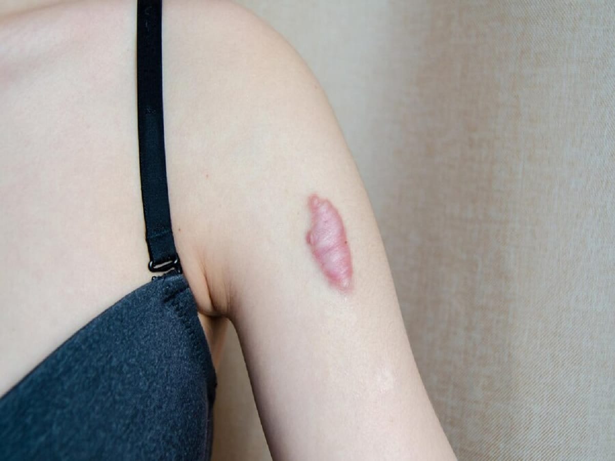 Keloid Scar Removal Treatment in Singapore | 1Aesthetics