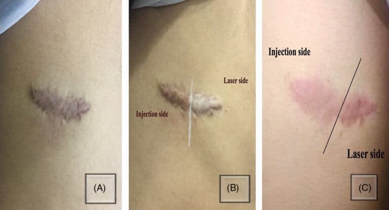 Is Laser Keloid Removal Suitable for You? Clinical Guide