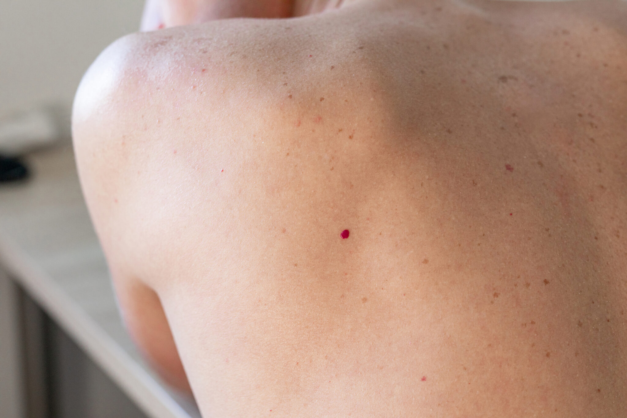 Laser Angioma (Red Mole) Removal Cost/Price - 1Aesthetics, Medical ...