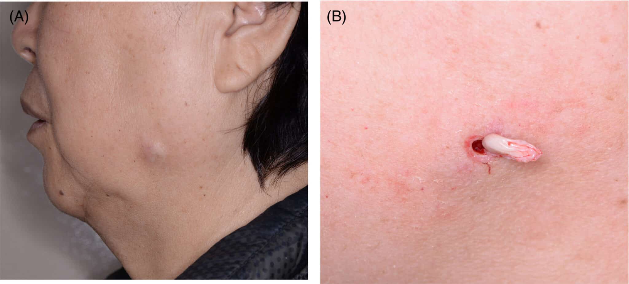 Sebaceous Cyst Removal in Singapore - Skin Cyst | 1Aesthetics