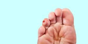 Wart Treatment Reimagined: Wart Removal Injections - 1Aesthetics ...